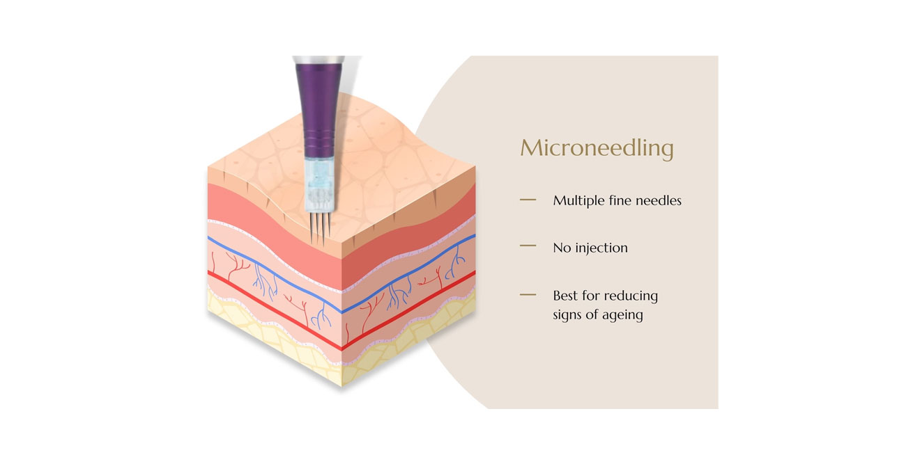 Mesotherapy vs. Microneedling: Understanding the Differences – Celesta ...